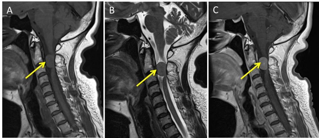 Spinal Meningioma Radiology Cases