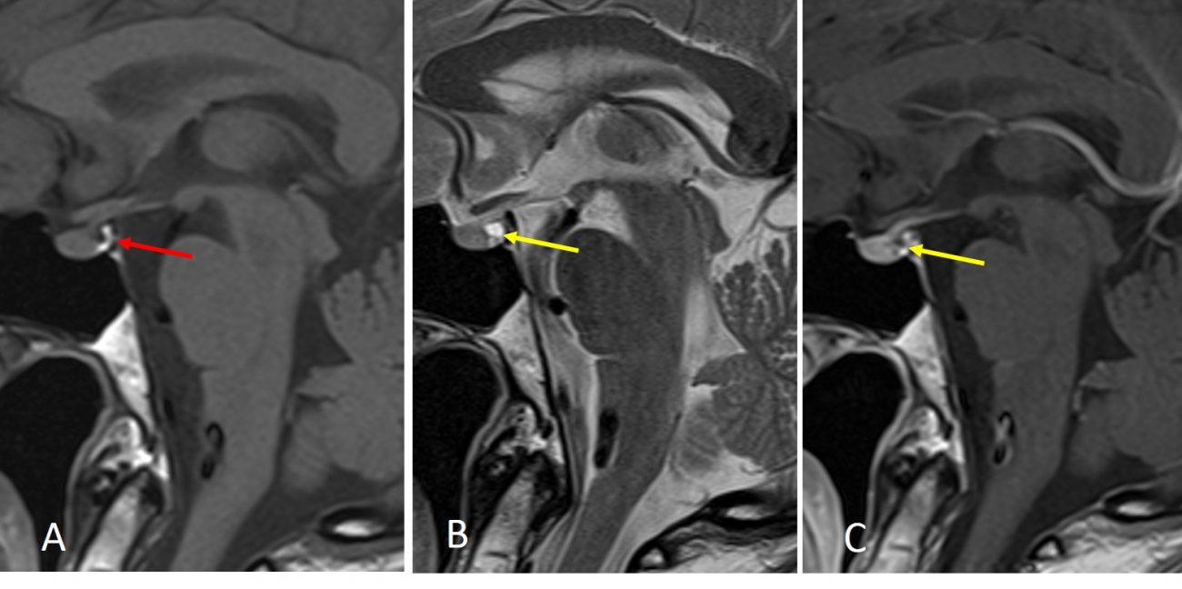 Rathke cleft cyst – Radiology Cases