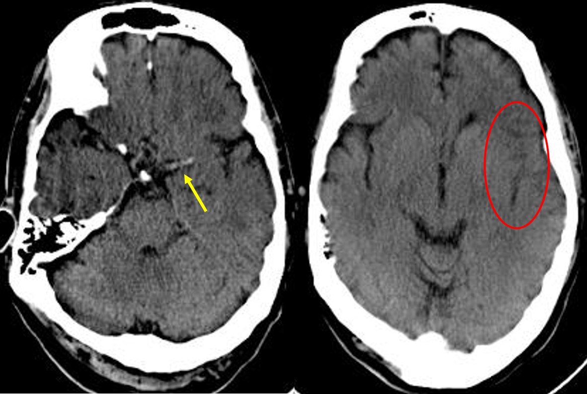 Hyperacute MCA infarction – Radiology Cases