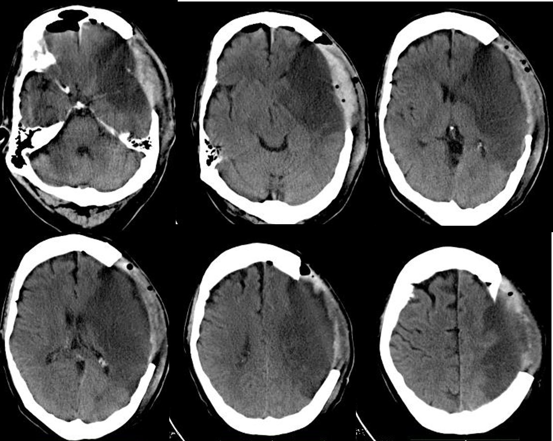 Hyperacute MCA infarction – Radiology Cases