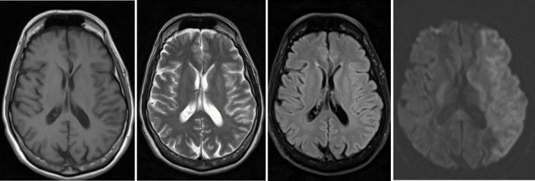 Hyperacute MCA infarction – Radiology Cases
