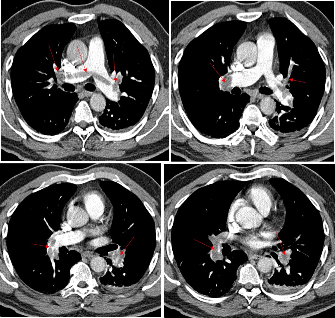 Saddle pulmonary embolism – Radiology Cases