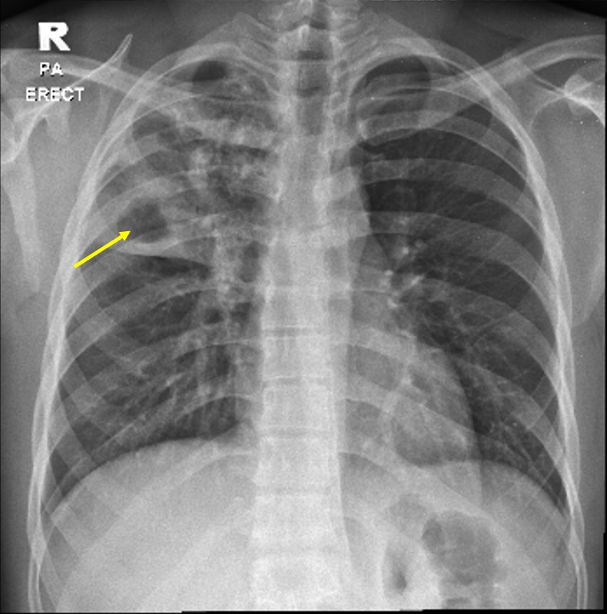 Pulmonary Tuberculosis Radiology Cases Pulmonary Tuberculosis Radiology Cases