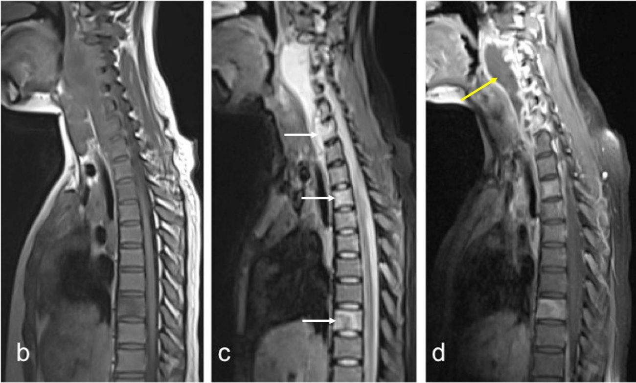 Tuberculous spondylitis – Radiology Cases