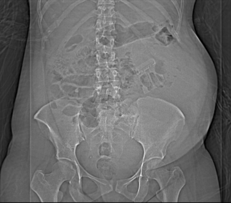 Ovarian Dysgerminoma Radiology Cases