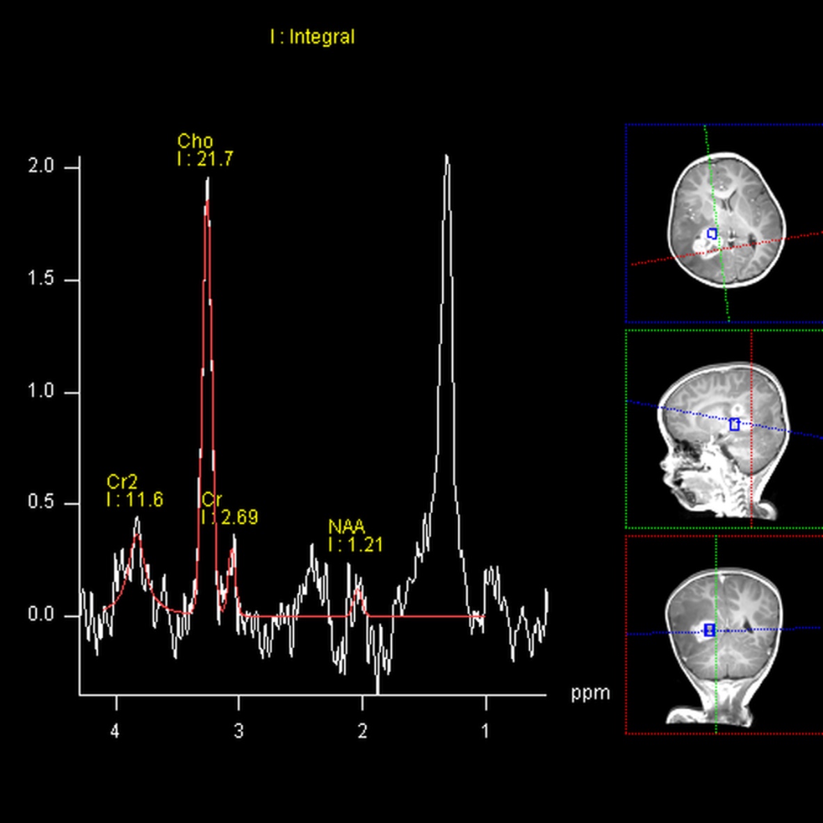 Choroid Plexus Carcinoma Radiology Cases