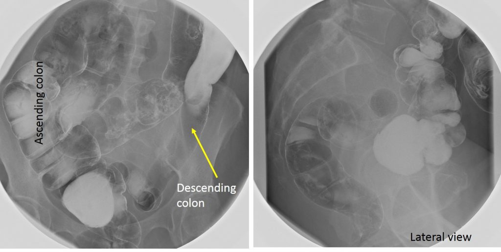 ‘lead Pipe Colon Sign Radiology Cases 7641