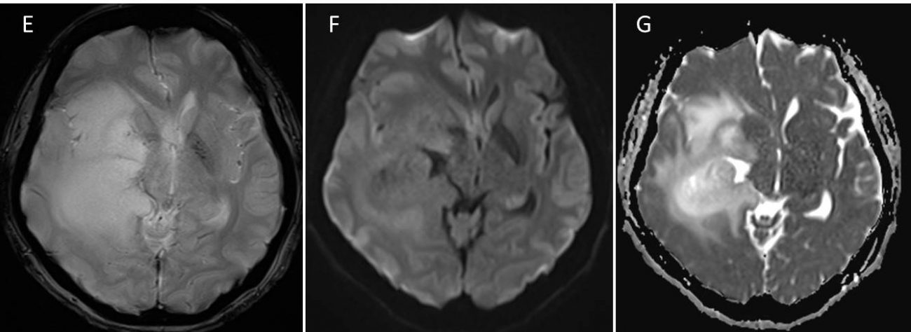 Diffuse astrocytoma – Radiology Cases