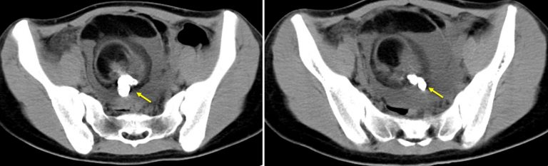 Mature Ovarian Teratoma Radiology Cases