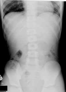 Gastric perforation following blunt abdominal trauma – Radiology Cases