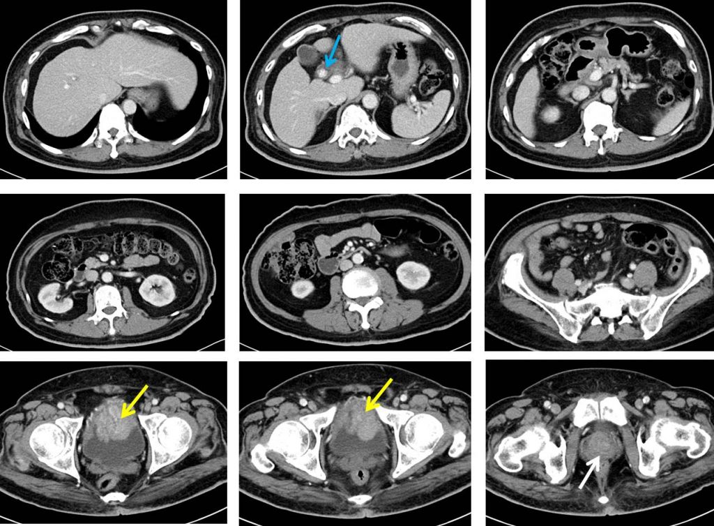 Synchronous Urinary Bladder And Prostate Cancer Radiology Cases