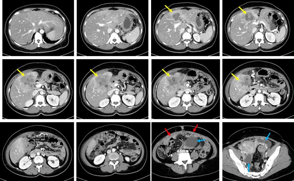 Mass-forming intrahepatic cholangiocarcinoma – Radiology Cases