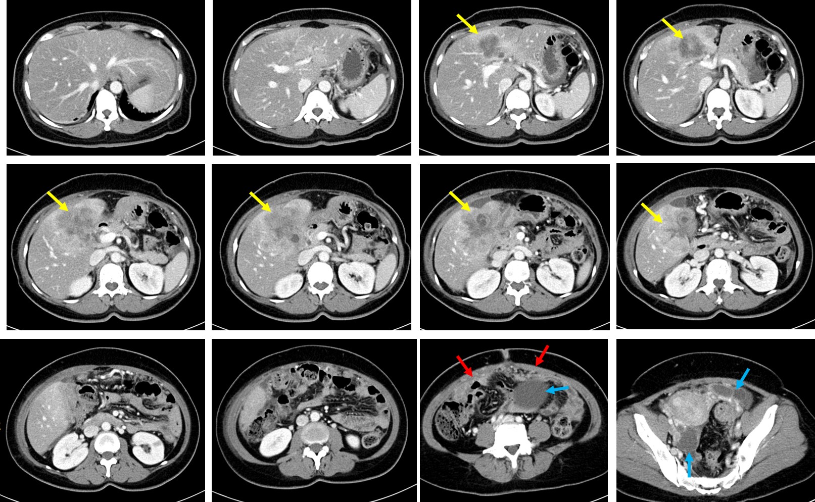 Mass-forming intrahepatic cholangiocarcinoma – Radiology Cases