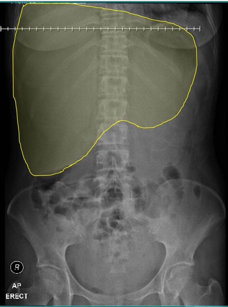 Elevated hemidiaphragm – Radiology Cases