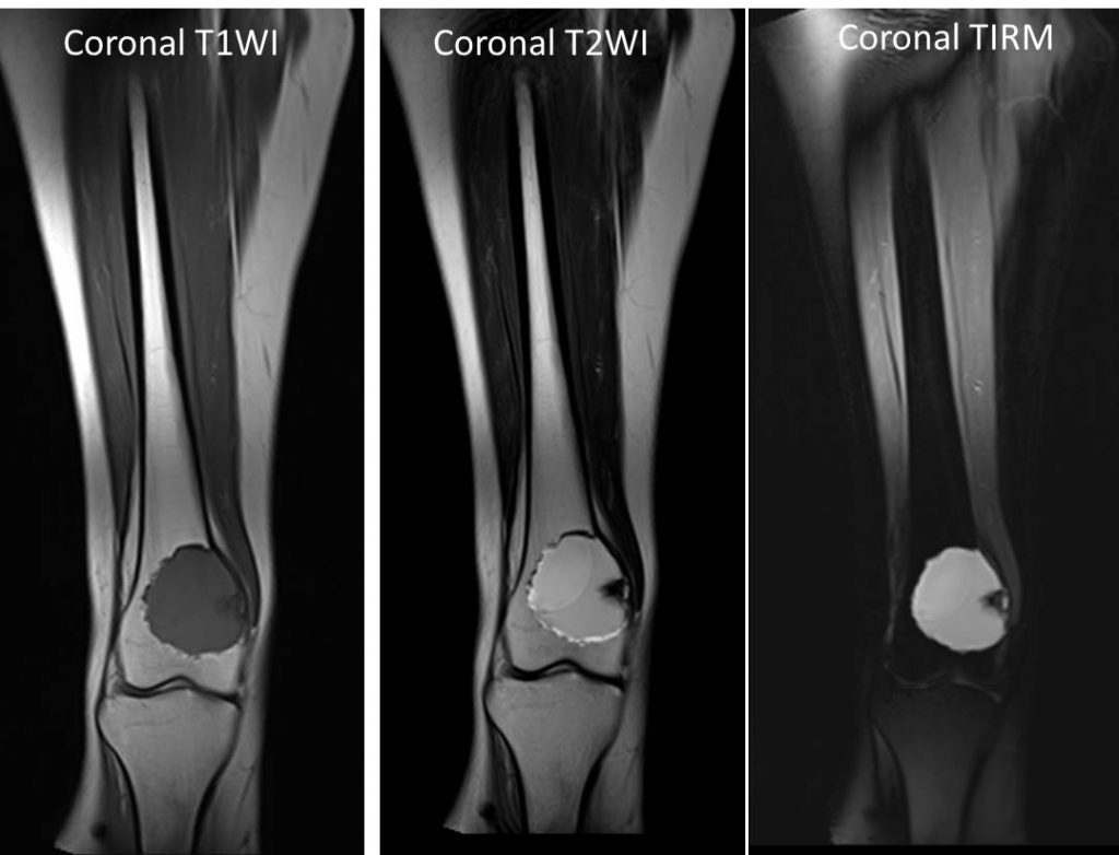 Aneurysmal bone cyst – Radiology Cases
