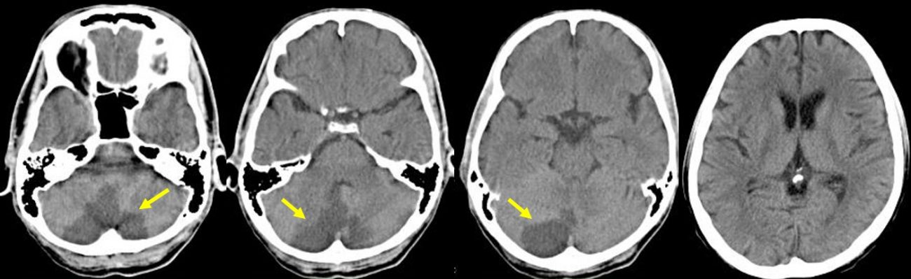 PICA infarction – Radiology Cases