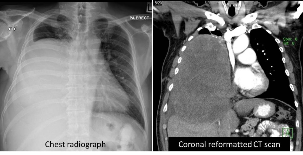 Metastatic lung sarcoma – Radiology Cases
