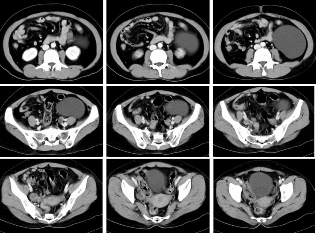 Mesenteric cyst – Radiology Cases