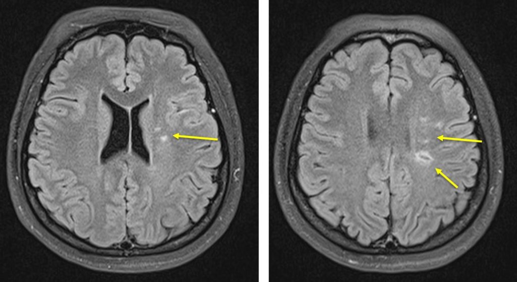 Young stroke with MCA stenosis – Radiology Cases