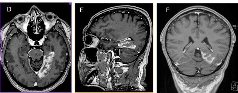 PCA infarction – Radiology Cases
