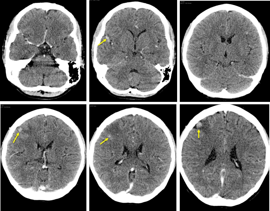 CNS tuberculosis – Radiology Cases
