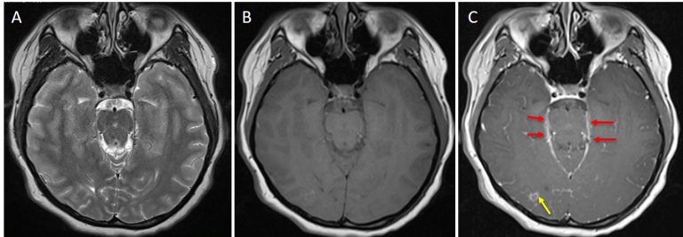 CNS tuberculosis – Radiology Cases