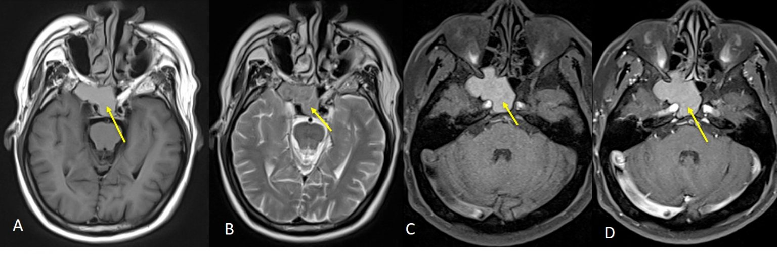 Mucocele – Radiology Cases