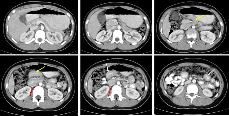 Midgut volvulus – Radiology Cases