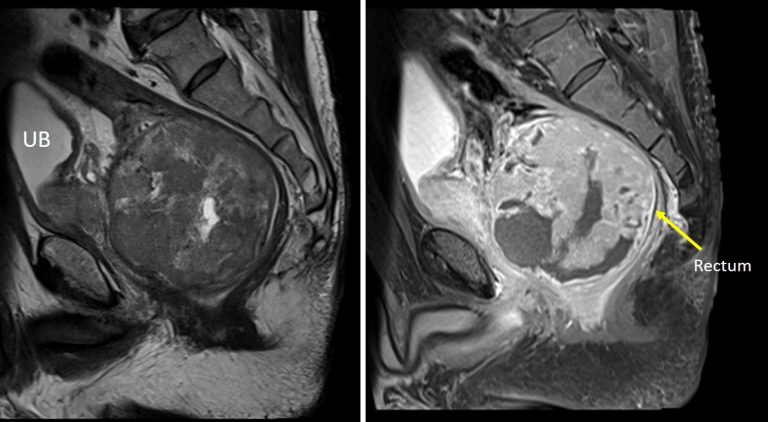 Rectal GIST – Radiology Cases