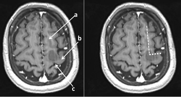 Central sulcus – Radiology Cases