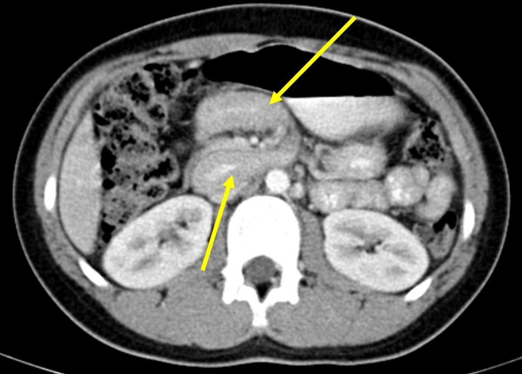 Midgut volvulus – Radiology Cases