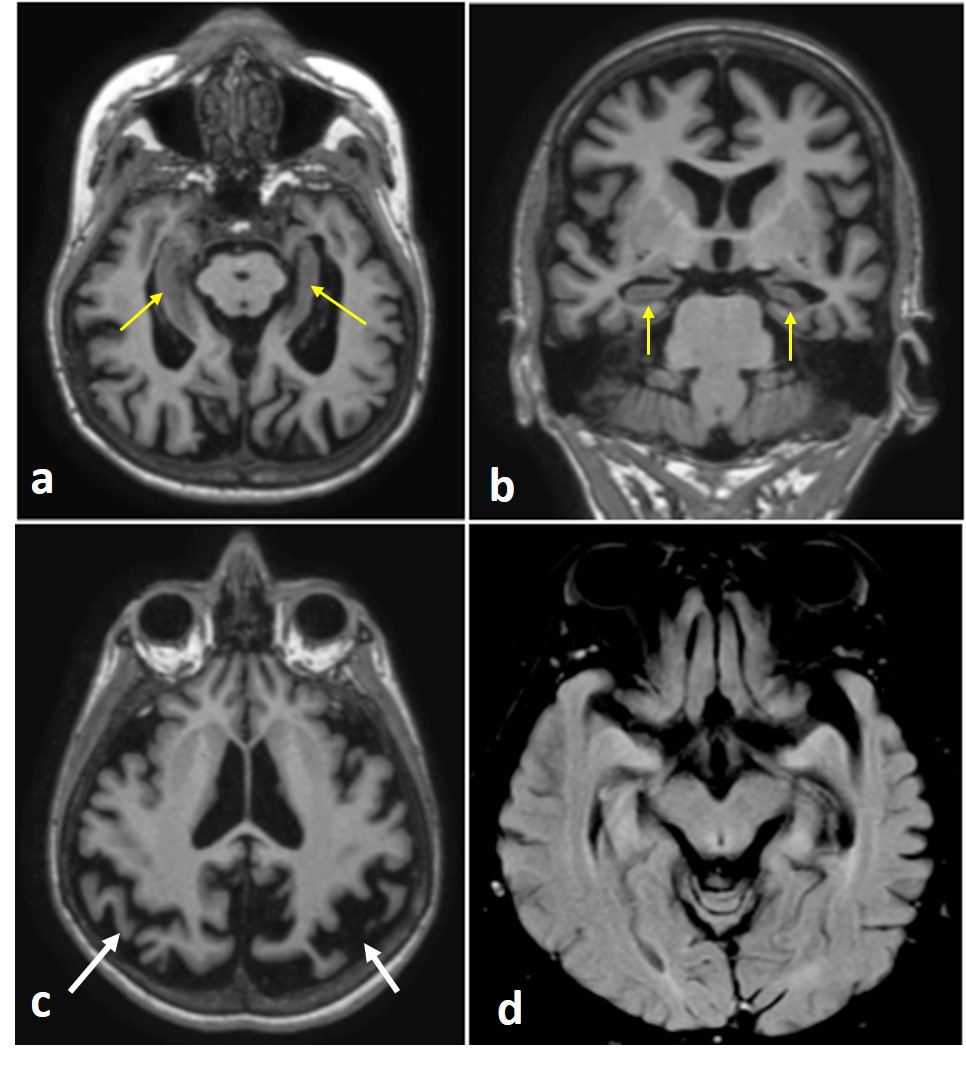Alzheimer Disease – Radiology Cases
