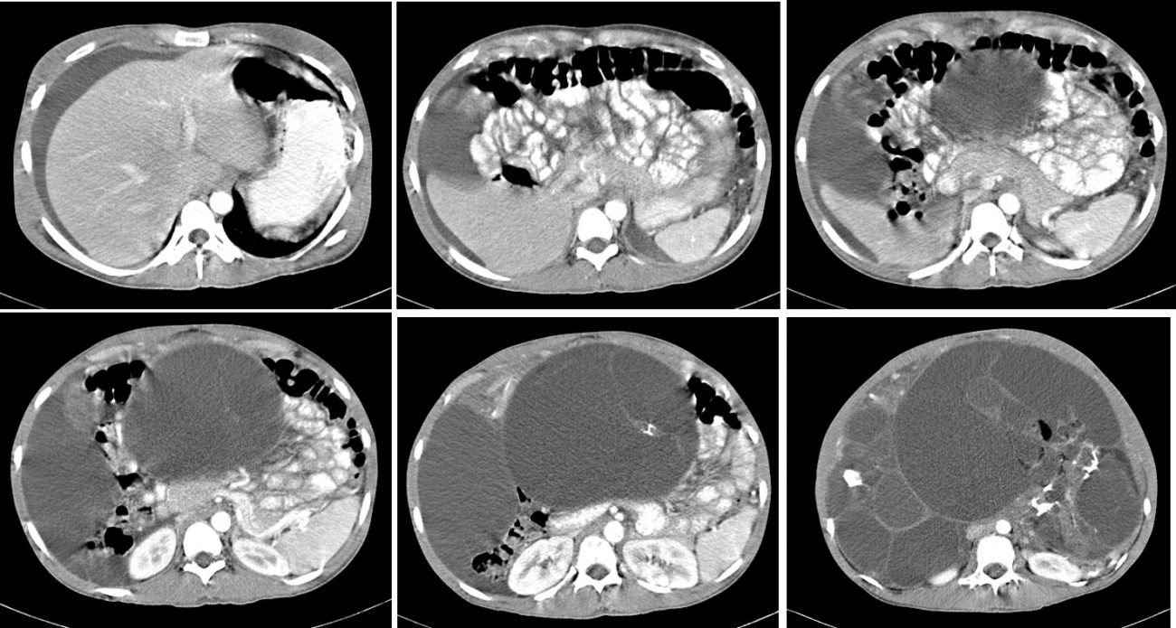 Lipogranuloma peritonealis caused by spontaneous rupture of benign ...