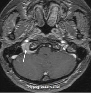 Hypoglossal schwannoma – Radiology Cases