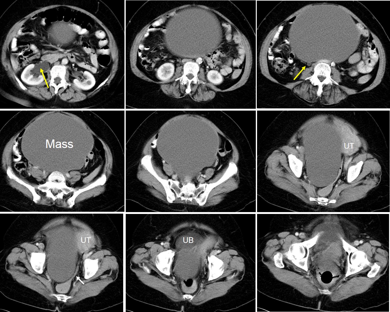 Borderline ovarian serous tumour – Radiology Cases