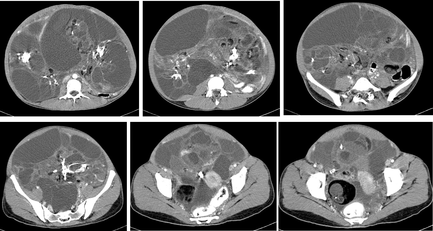 Lipogranuloma peritonealis caused by spontaneous rupture of benign ...