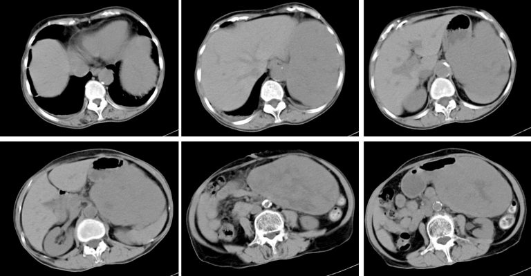 Stomach GIST – Radiology Cases