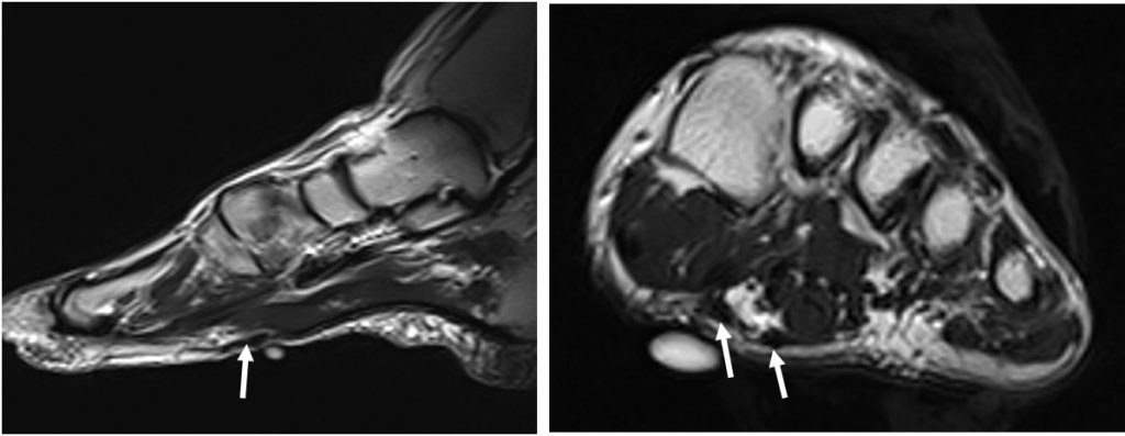Plantar fibromatosis – Radiology Cases