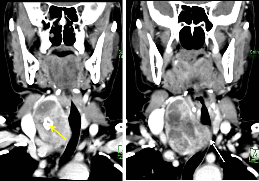 Papillary thyroid carcinoma – Radiology Cases