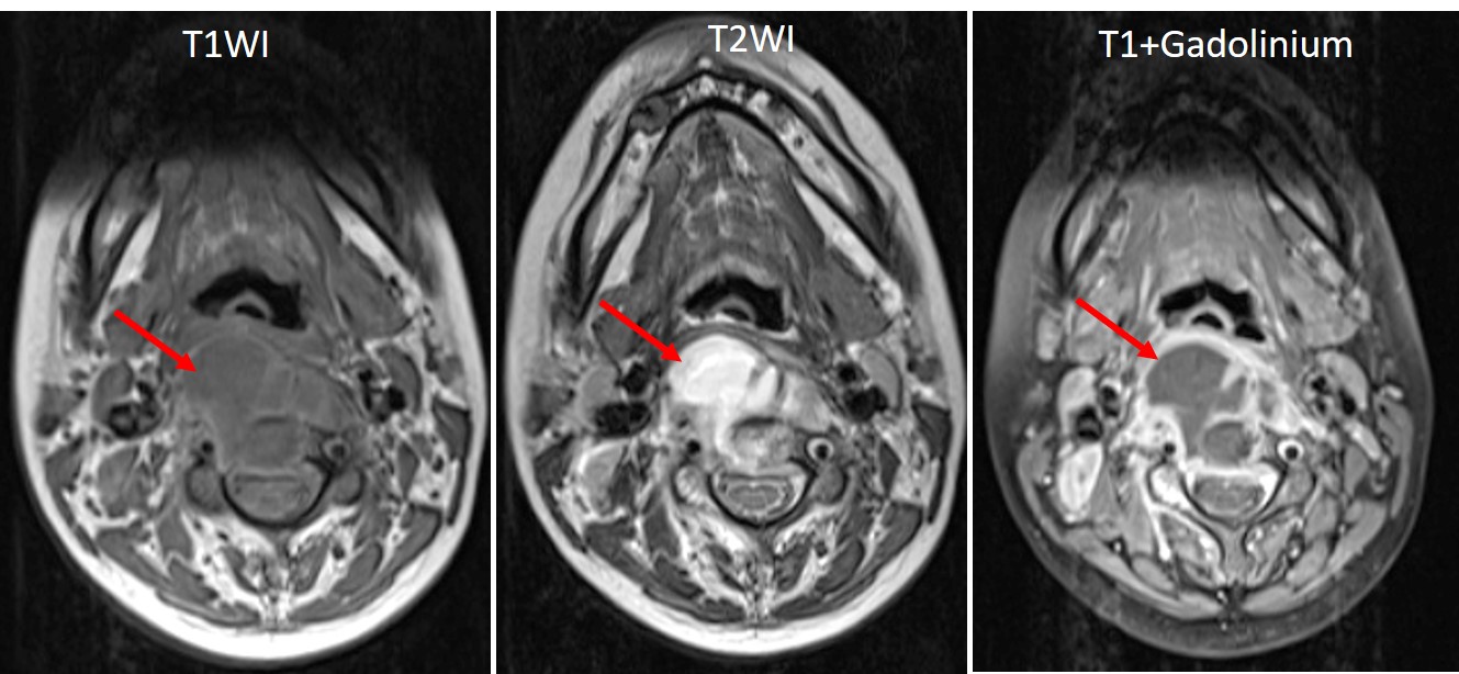 Tuberculous spondylitis – Radiology Cases