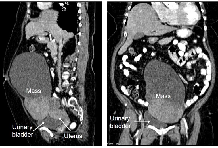 Twisted gangrenous ovarian mucinous cystadenoma – Radiology Cases
