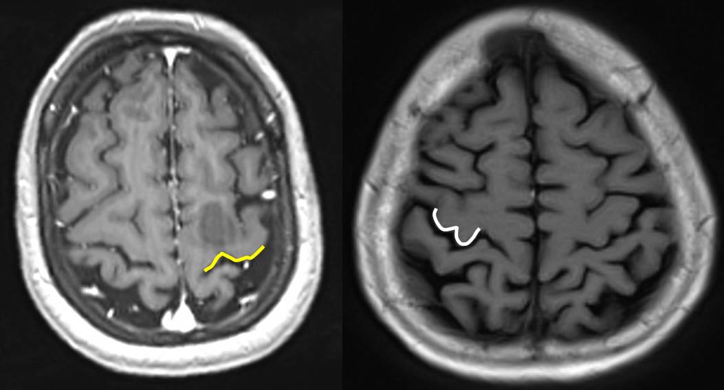 Central sulcus – Radiology Cases