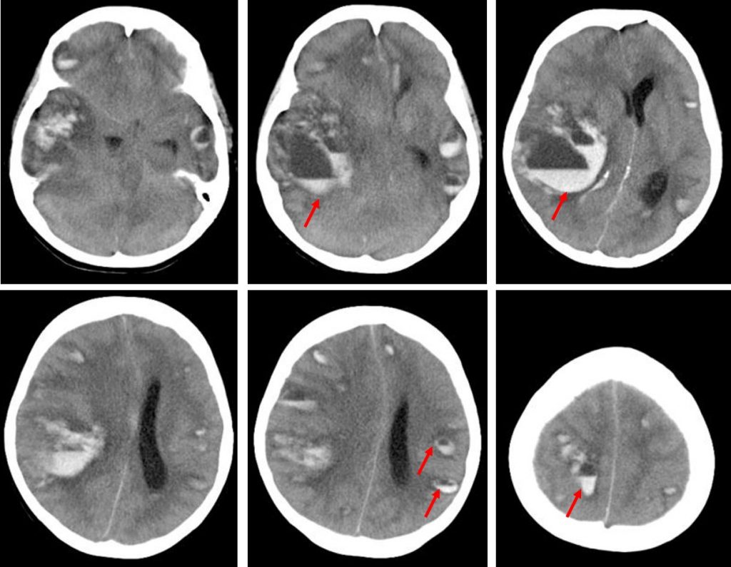 Intraparenchymal haemorrhage with fluid-blood levels – Radiology Cases