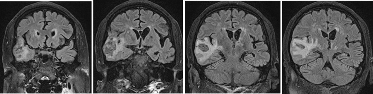 MCA infarction or HSV encephalitis? – Radiology Cases