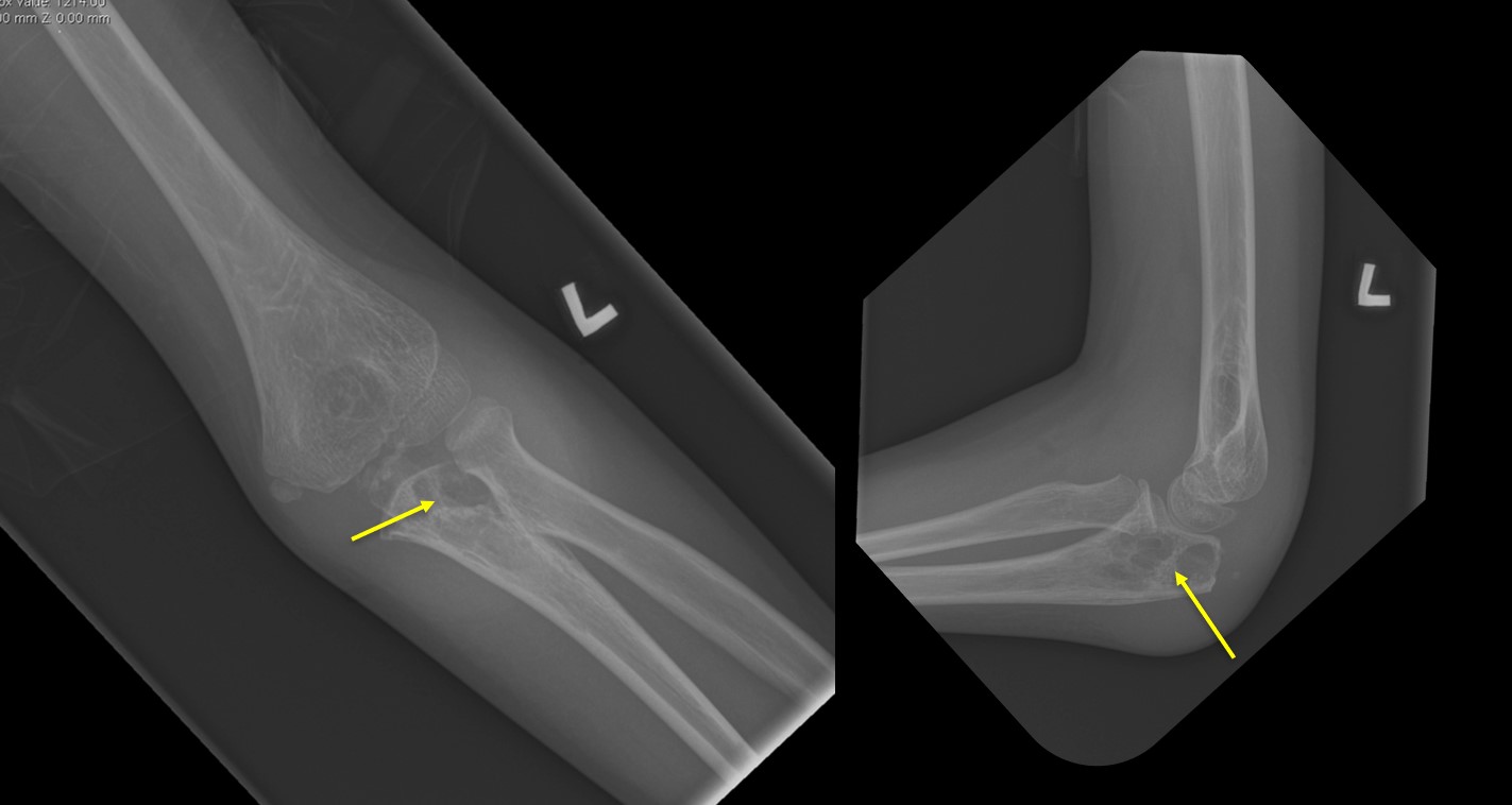 Disseminated tuberculosis – Radiology Cases