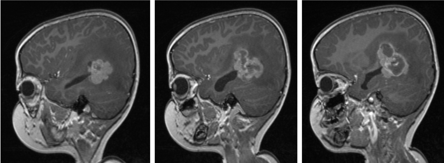 Choroid plexus carcinoma – Radiology Cases