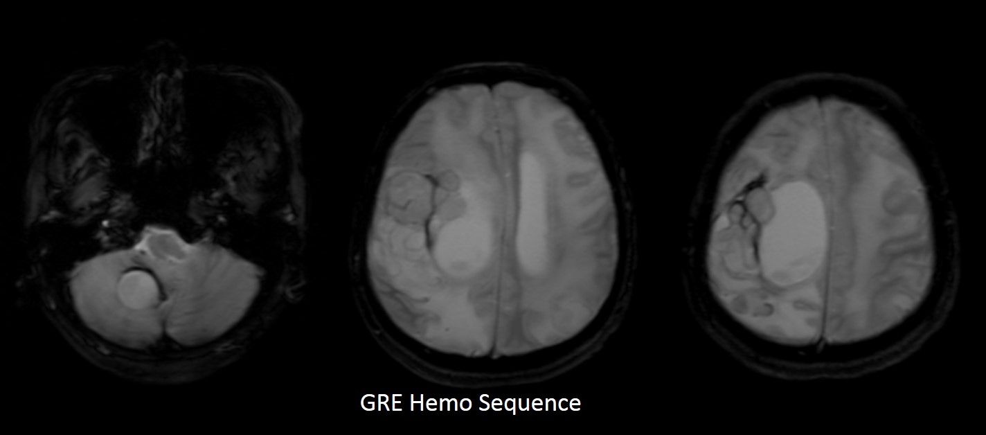 CNS TB: Tuberculomas – Radiology Cases