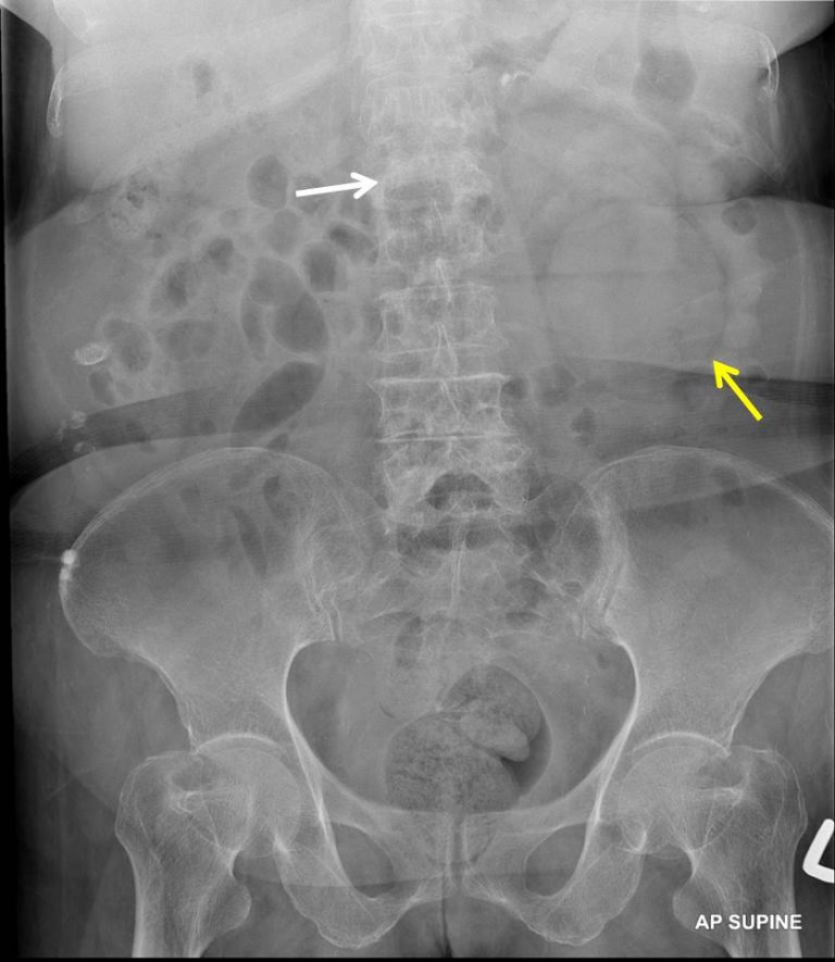 Renal cysts – Radiology Cases
