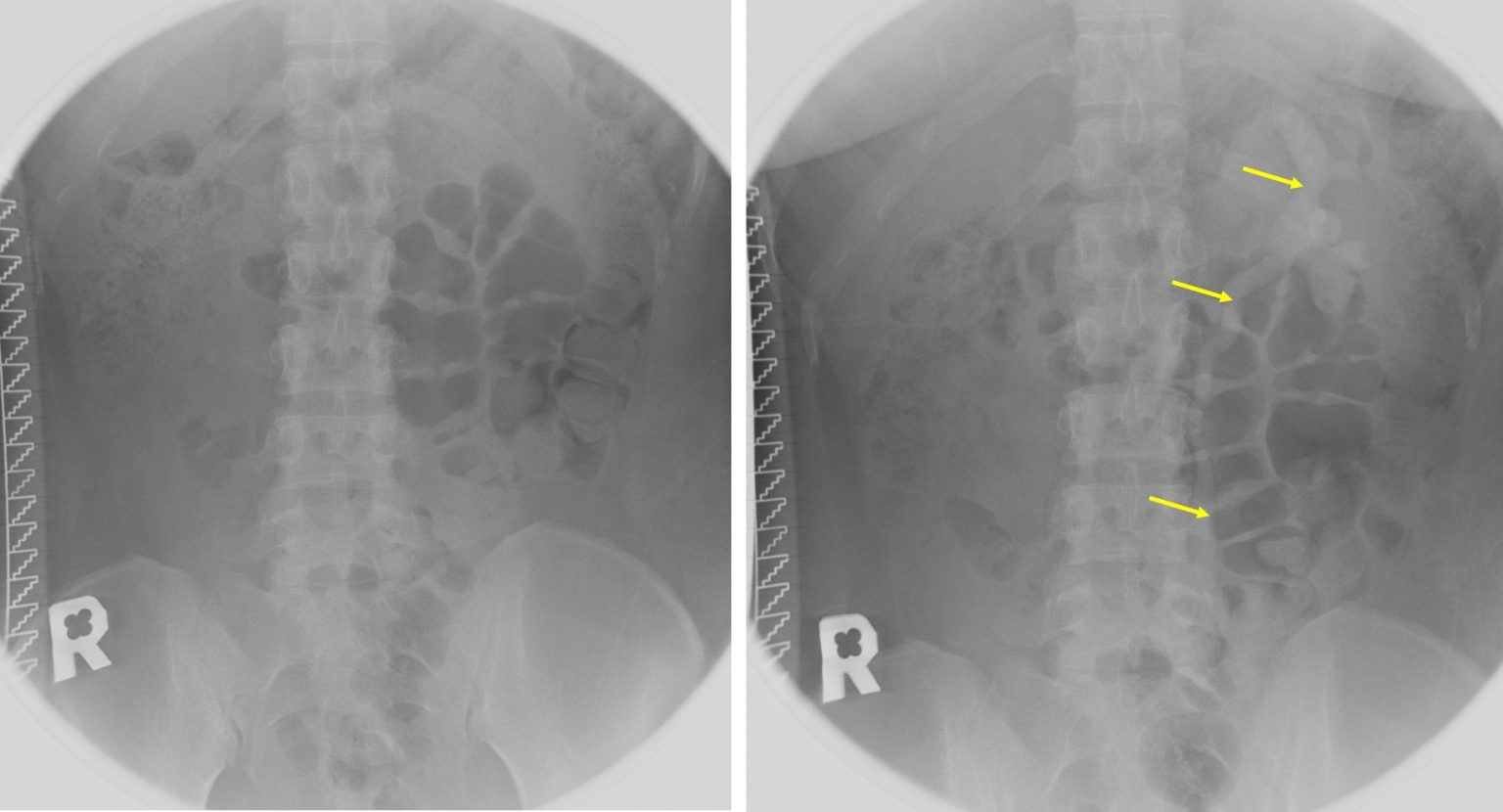 Unilateral renal agenesis – Radiology Cases