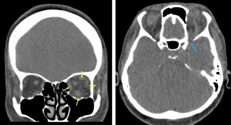 Carotid cavernous fistula – Radiology Cases